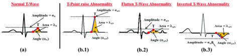 T Wave Abnormality Detection Method A Normal T Wave B 1 B 3 Download Scientific Diagram