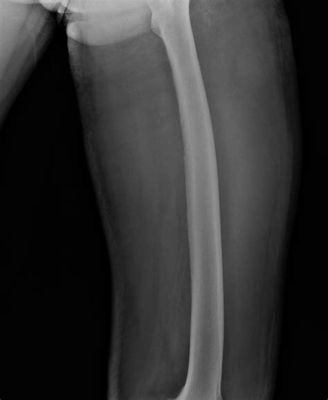 Tratamiento Fisioterapéutico Para Hematoma Intramuscular En Madrid