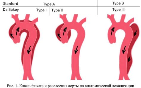 Pdf Aortic Dissection Classification Etiology Pathogenesis And
