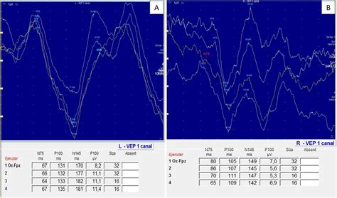 Sensitivity And Specificity Of Visual Evoked Potentials For Early Diagnosis Of Demyelinating