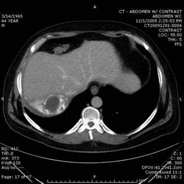 Cholangitis Abdominal Key