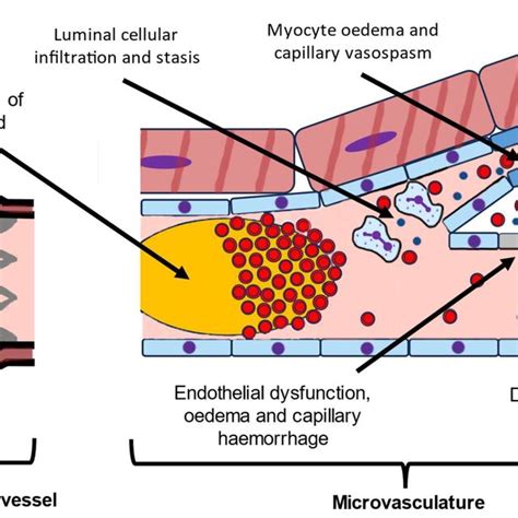 Schematic Figure Highlighting The Pathophysiological Process Of