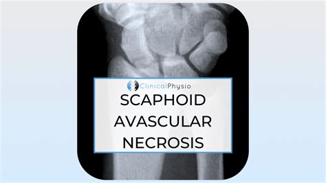 Scaphoid Avascular Necrosis Clinical Physio Membership