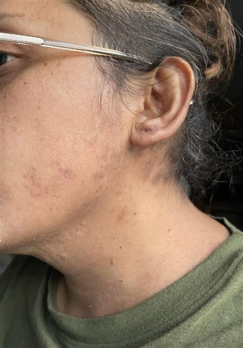 Shingles Around Ear And Neck Rshingles