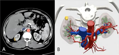 Renal Tumor 3d Reconstruction And Traditional Ct Scans A General Ct