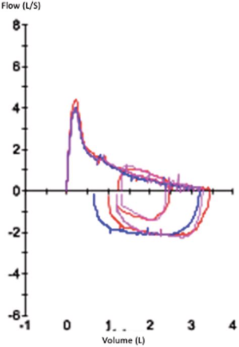 Flow Volume Loop Of The Pulmonary Function Tests June Download Scientific Diagram