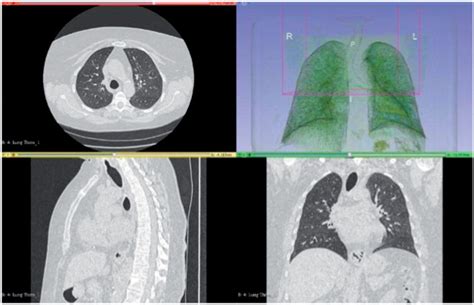 An Example Of A Ct Scan Undergoing Conversion Using A 3d Slicer Download Scientific Diagram