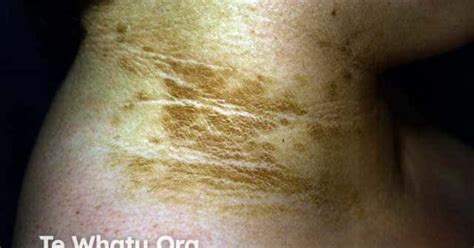 Acanthosis Nigricans Image