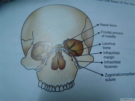 Fracture Maxilla Pptx Dr Wafaa Muhadharaty