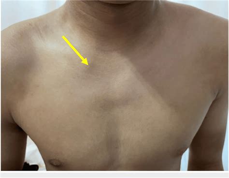 [pdf] Posterior Dislocation Of The Sternoclavicular Joint In A Patient