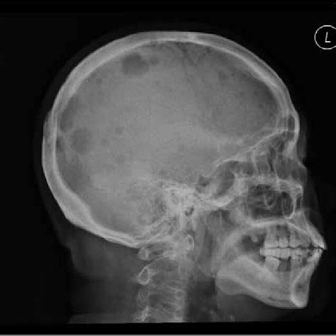Skull Radiograph Showing Multiple Osteolytic Lesions Download