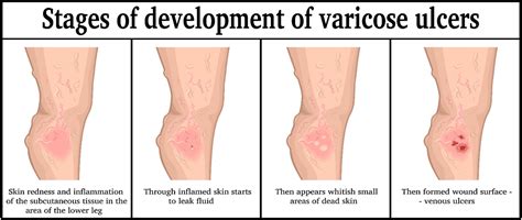 Venous Leg Ulcers Treatment New York Vein Treatment Center