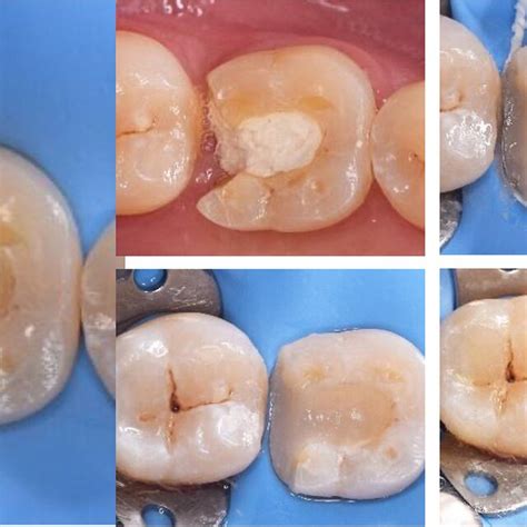 Representation Of The Workflow From Preparation To Cementation Of The