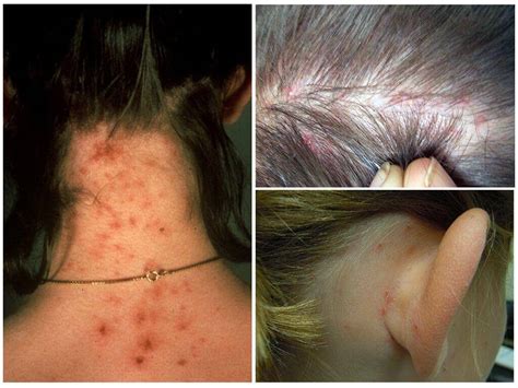 ᐉ Вши фото как выглядят укусы вшей на теле голове и волосах человека