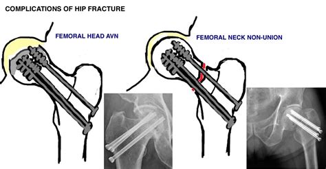 Failed Surgery Of Hip Fracture — Hip And Knee Book