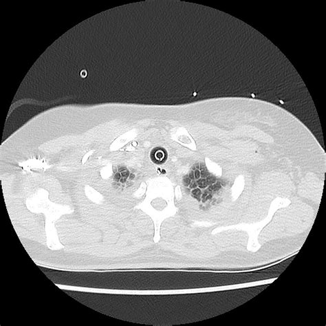 Acute Pulmonary Edema On Ct Radiopaedia 33582 34672 Axial Lung Window Nc Commons