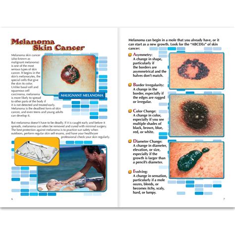 Skin Cancer Brochure Printable