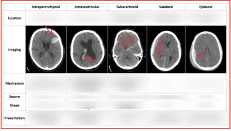 Diagram Of Different Bleeds In The Brain And Their Characteristics Quizlet
