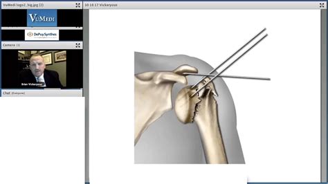 Proximal Humerus Fractures Im Nailing With Brian Vickaryous Md Johnson And Johnson Institute