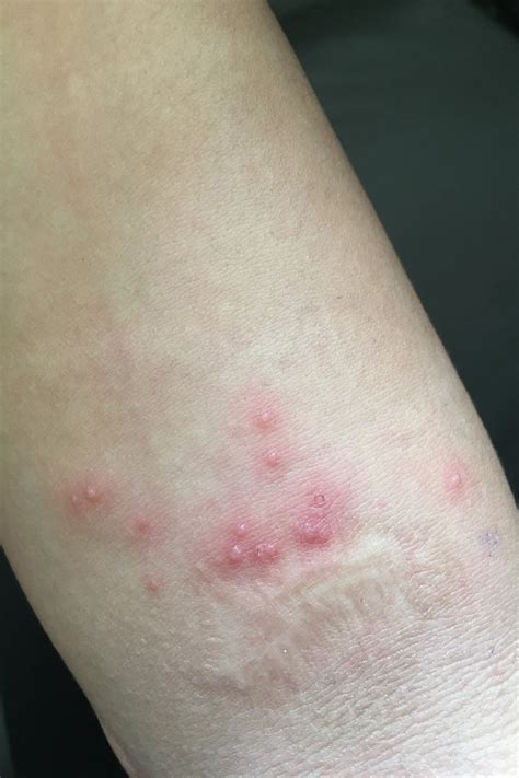 Scabies On Arms And Legs