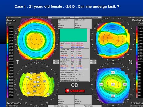 Corneal Topography Eyewiki