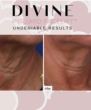 Divine Rf Pyramid Facelift Non Invasive Face Lift Desert Divas