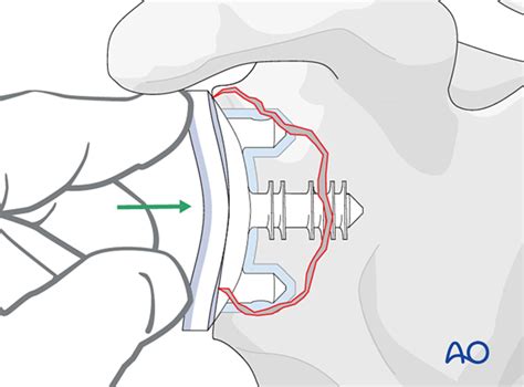 Revision Of An Anatomic All Polyethylene Glenoid Component For Glenoid