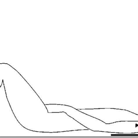 Bilateral Shoulder X Rays Showing Anterior Shoulder Dislocation With