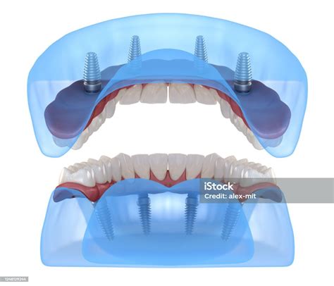 임플란트가 지원하는 4개의 시스템에 잇몸 모두와 함께 하는 상악 및 만디큘러 보철 인간의 치아와 의치의 의학적으로 정확한 3d 그림 건강관리와 의술에 대한 스톡 사진 및