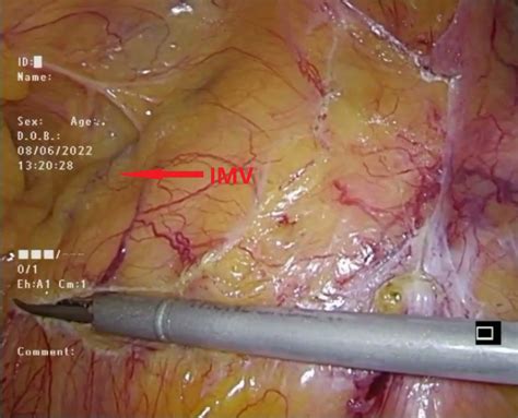 A novel technique for NO.253 lymph node dissection and left colic artery preservation to avoid ...