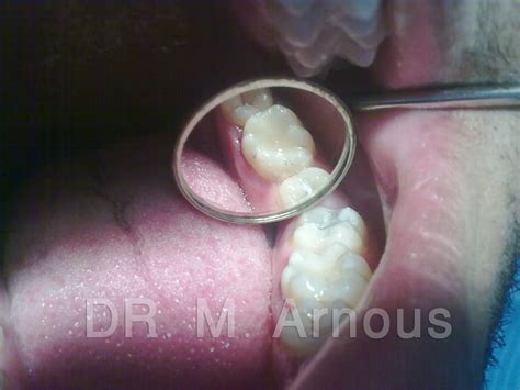 Dr Mohammed Arnous Class I Amalgam Restoration Class I Composite
