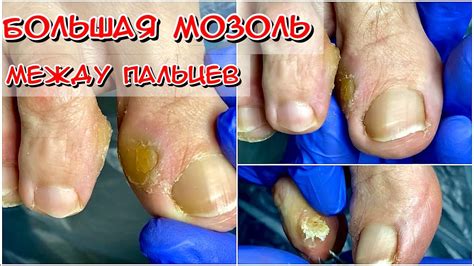Большая мозоль между пальцев / Целующиеся мозоли / мозоль от обуви ...