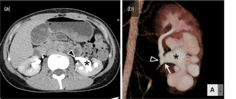 Postoperative Ct Findings Ct Delayed Urography In The Transverse Plane