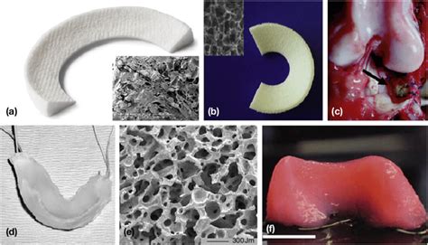 Examples Of Meniscus Tissue Engineering Products On The Market And In