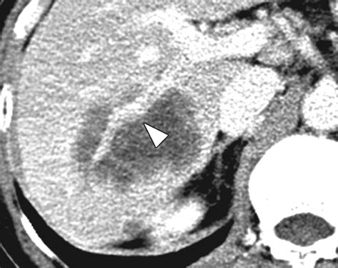Varying Appearances Of Cholangiocarcinoma Radiologic Pathologic