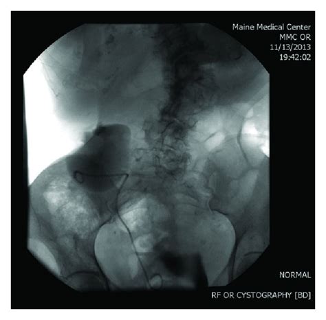 Right Retrograde Pyelogram Conducted The Following Day Indicating Download Scientific Diagram