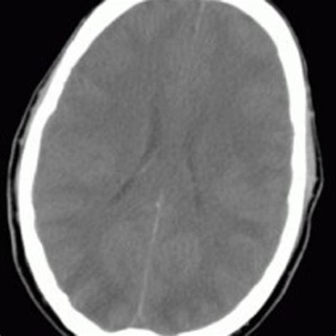 Non Contrast Computed Tomography Showing Diffuse Cerebral Edema Download Scientific Diagram
