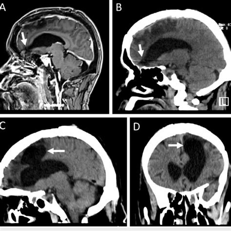 A Mri And B Ct Showing Ventricle Descending Into Defect In