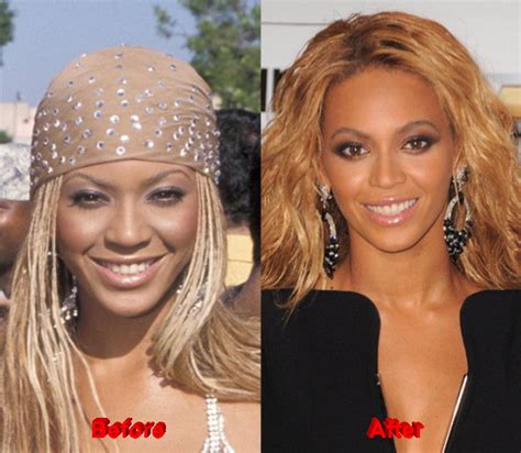 Beyonc Plastic Surgery Did The Singer Lighten Her Skin