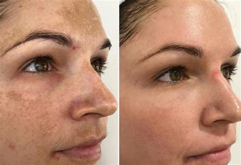 Hyperpigmentation Treatment London Premier Laser And Skin Clinic