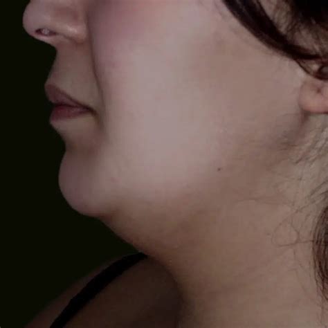 Liposuccion Laser Avant Après Lypolyse Estetika Tour 2024