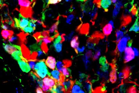 Newly Discovered Gene Mutation Linked To Neurodevelopmental Disorders