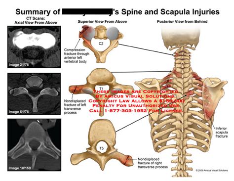 Amicus Illustration Of Amicusinjuryspinescapulactcompression