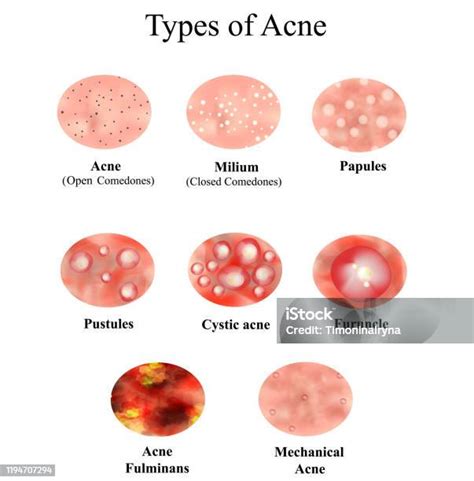 여드름 피부 염증의 종류 여드름 종기 흰 머리 닫힌 혜성 구진 농포 낭포성 여드름 인포 그래픽 격리된 배경에 대한 벡터
