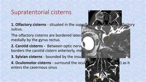 Ventricles And Cisterns Of Human Brain Pptx Brain And Nervous System Disorders Diseases And