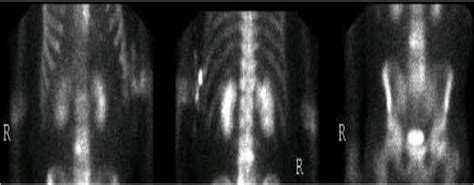 Three Phase Bone Scan Showing Focal Abnormal Radiotracer Accumulation