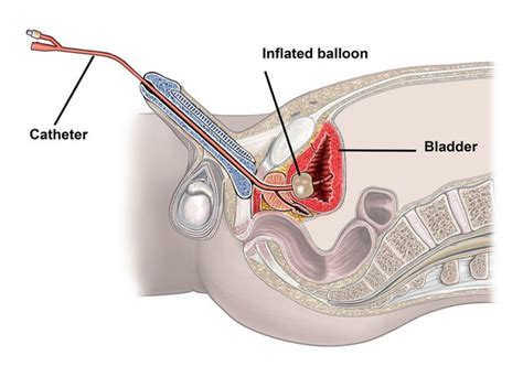 Urinary Catheter Types HSE Ie