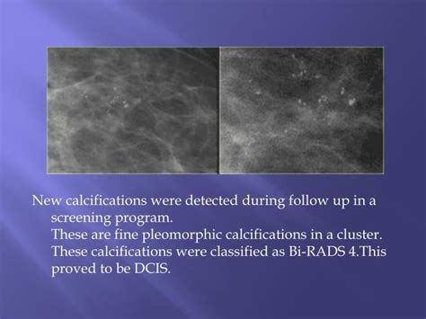 Ppt Breast Calcifications Differential Diagnosis And Birads Powerpoint Presentation Id 3713492