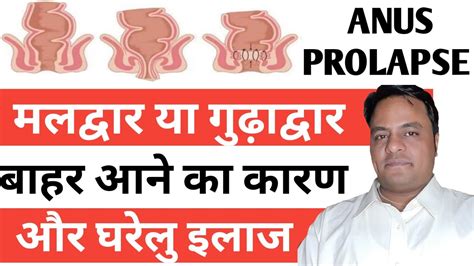 Acupressure Points For Anus Prolapse। Sujok Therapy। Maldwar Ya Gudda
