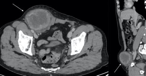 Malignant Solitary Fibrous Tumor Of The Inguinal Region A Case Report